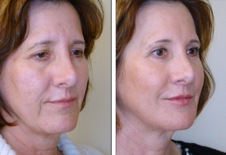 Fractional Laser Treatments in Oakland County MI | FACE Beauty Science ...