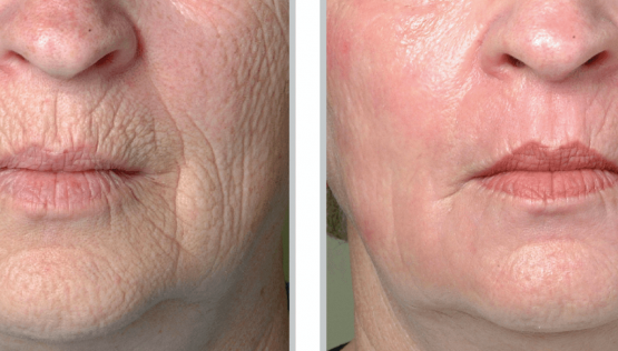 Laser Skin Resurfacing Birmingham | Contour TRL Bloomfield Hills | Face ...