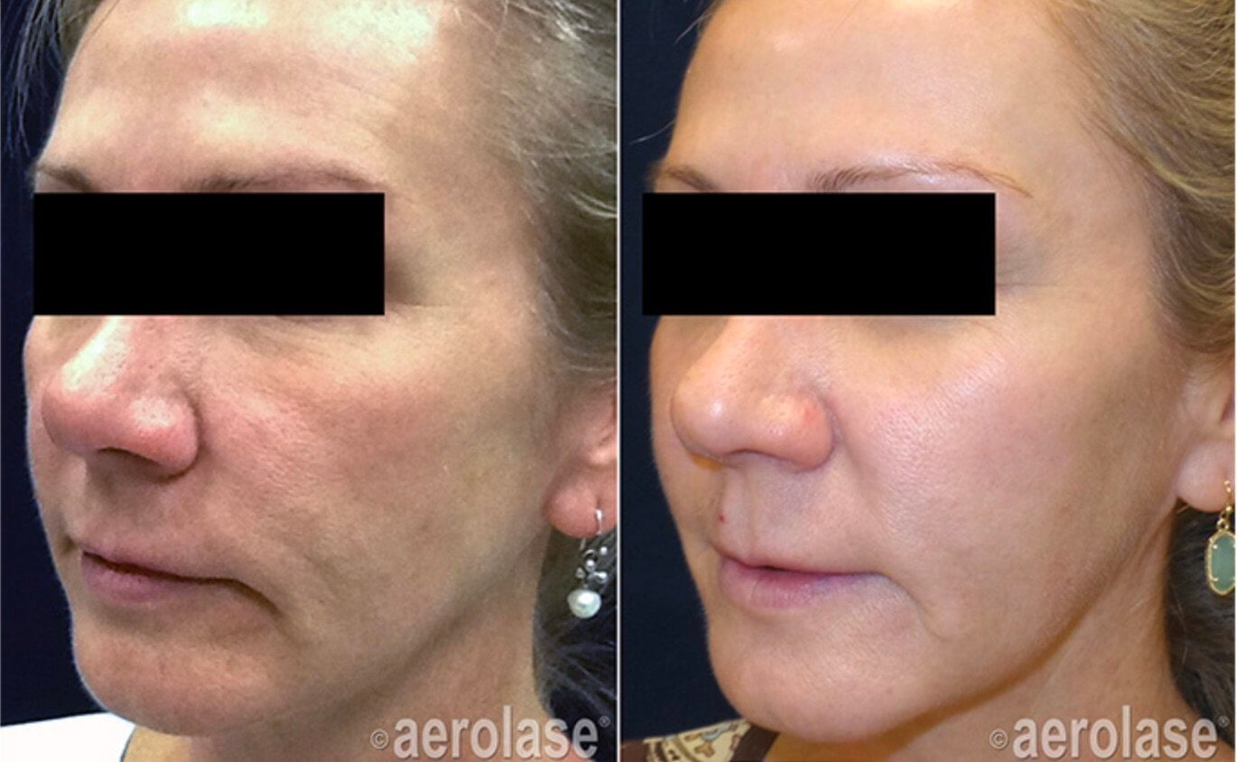 Aerolase LightPod Neo Laser Oakland County MI | FACE Beauty Science ...