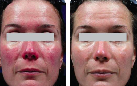 excel® V CoolView Laser Treatment Oakland County MI | FACE Beauty ...