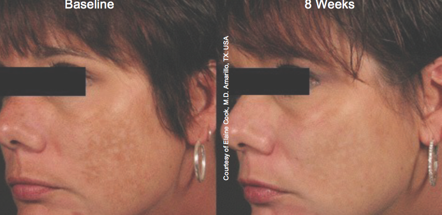 DiamondGlow Birmingham | Dermalinfusion Oakland County MI | Face Beauty ...