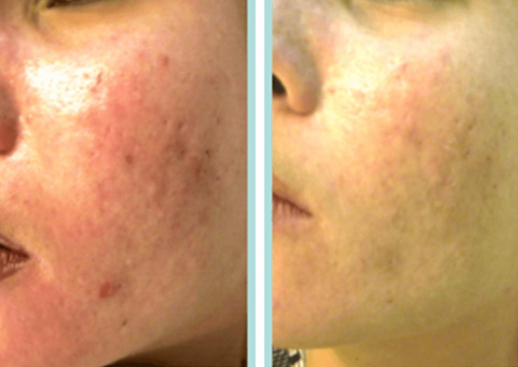 Facials Birmingham | SaltFacial Oakland County MI | Face Beauty Science